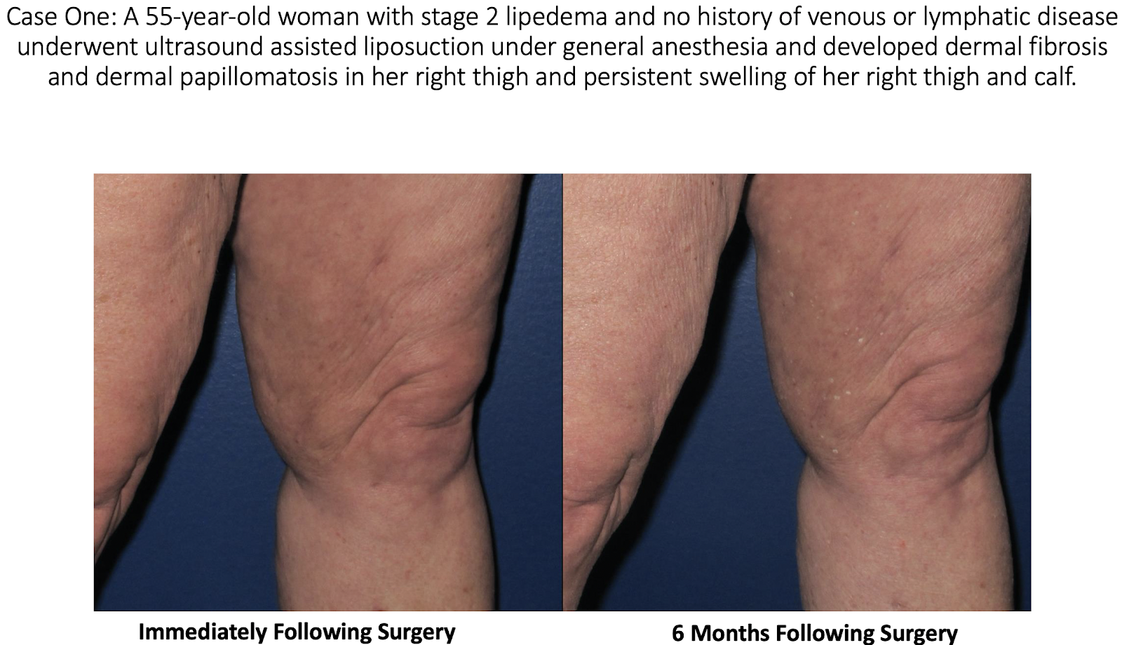 Lymphatic Injury After Liposuction for Lipedema - St Louis Laser Veins
