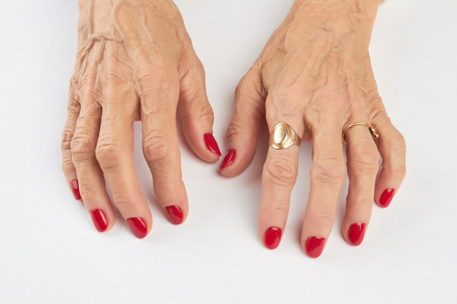 Sclerotherapy Can Treat Pesky Hand Veins | St Louis Laser Vein