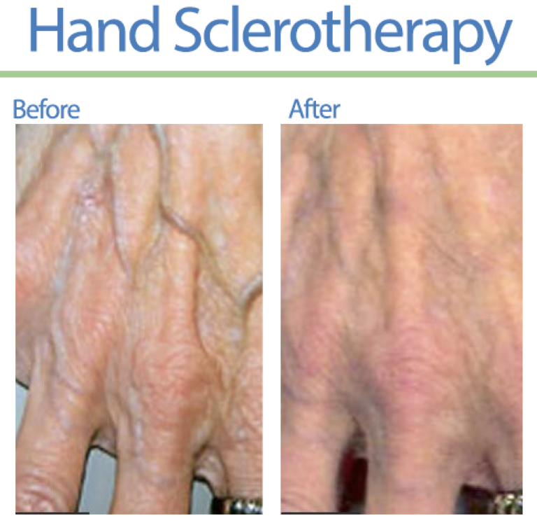 The Benefits of Sclerotherapy for Vein Health | Laser Vein Center