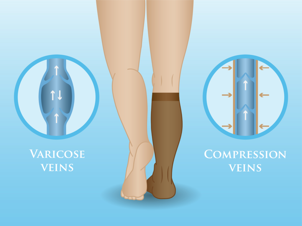Compression Therapy for Vein Health - St Louis Laser Veins