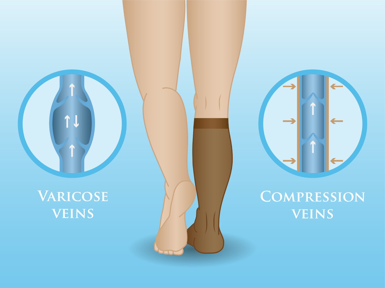 Compression Therapy for Vein Health - St Louis Laser Veins