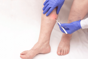 Alternative Treatments to Vein Stripping | St Louis Laser Veins