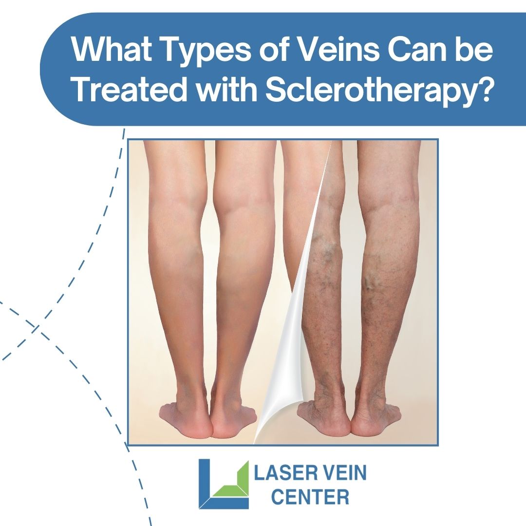 Types of Veins that Can Be Treated with Sclerotherapy | St Louis Laser ...
