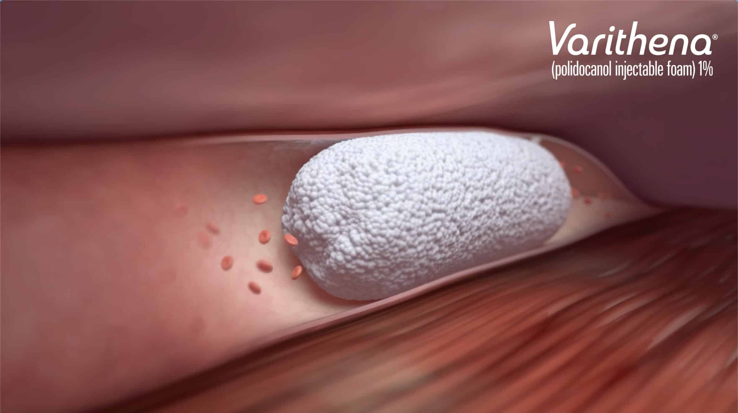 Varithena® Treatment in St. Louis and O'Fallon, MO: Complete Guide to Nonsurgical Varicose Vein ...